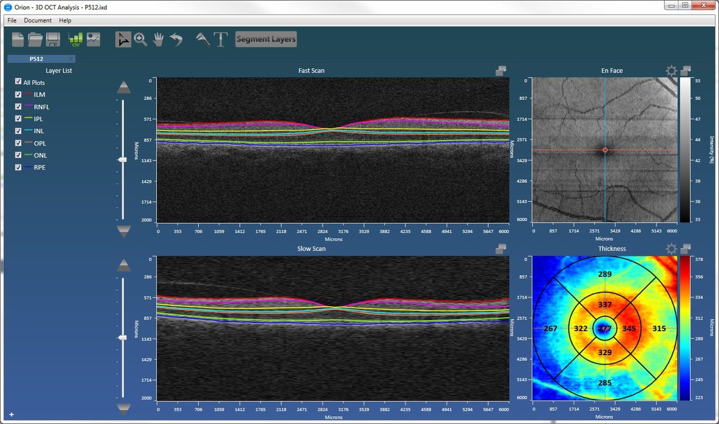 Orion Is In Beta - Voxeleron Prepares The Release Of Their Advanced OCT Analysis Software ...